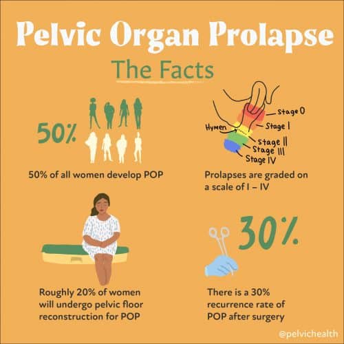 Pelvic Floor Physical and Occupational Therapy Helps Pelvic Organ Prolapse