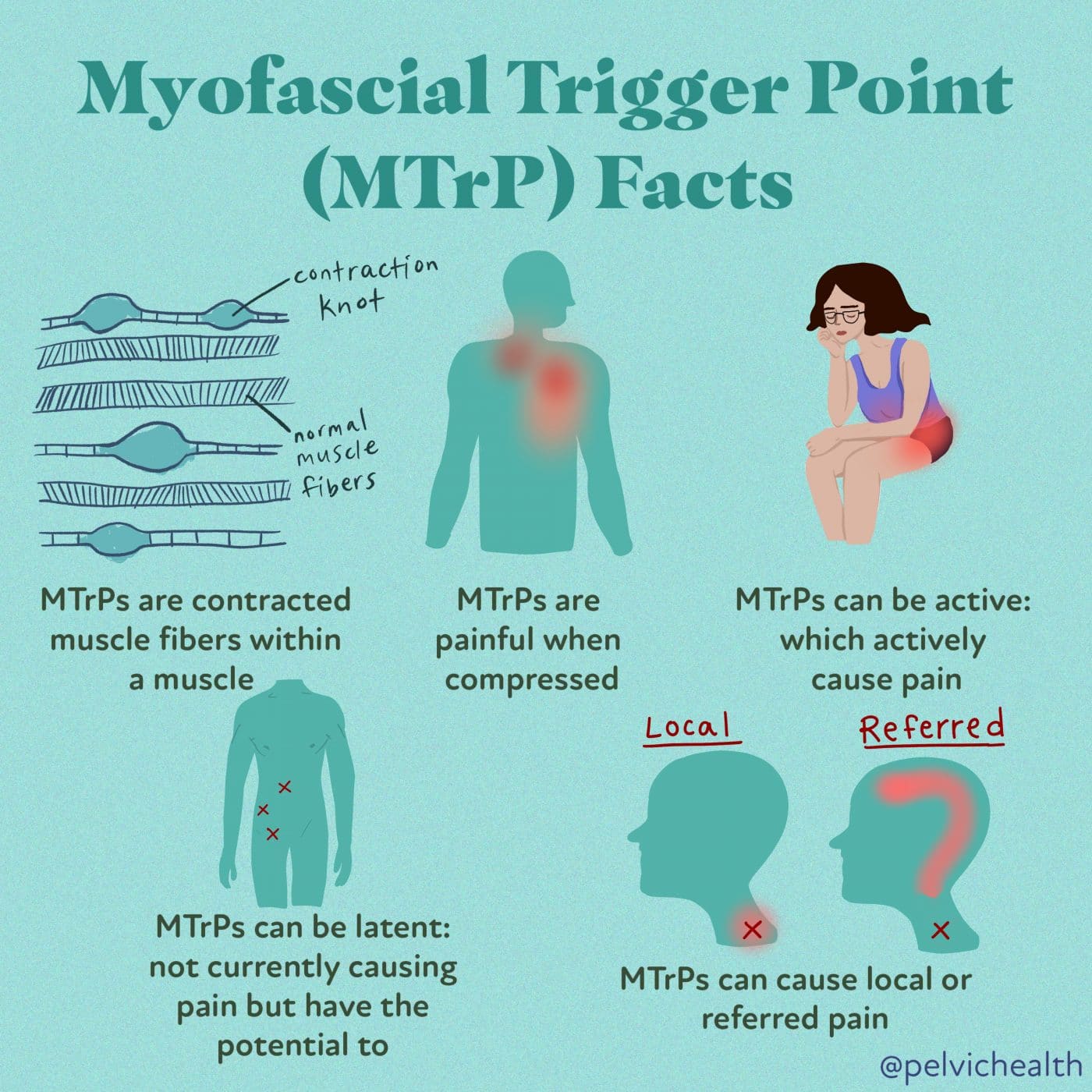 Myofascial Trigger Points: Facts & General Information