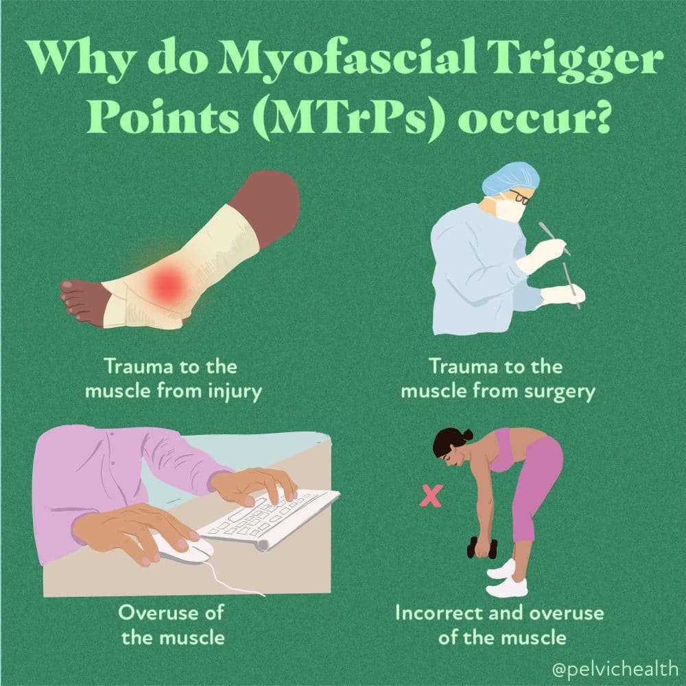 Myofascial Trigger Points: Facts & General Information