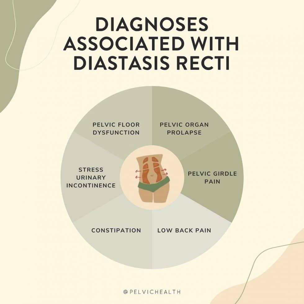 Diastasis Recti: Causes and Treatment