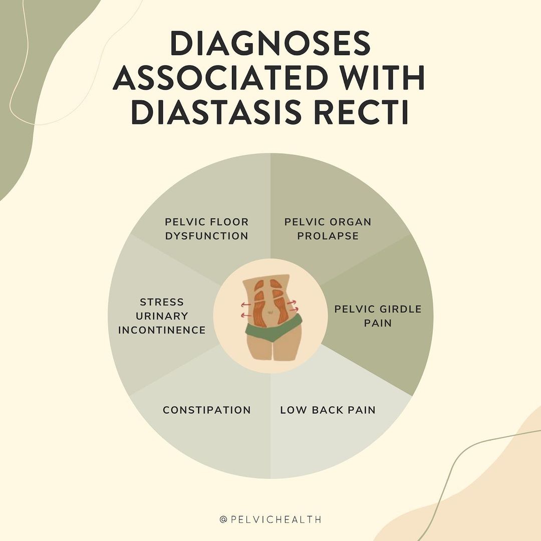 Diastasis Recti: Causes and Treatment