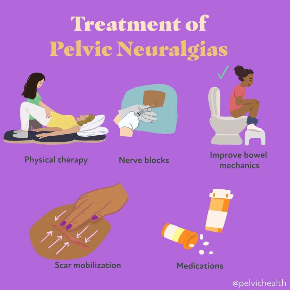 Pelvic Neuralgias: General Info, Causes, and Treatment
