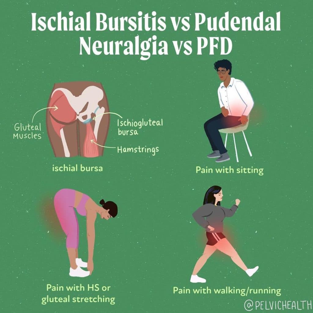 What is Ischial Bursitis and How Can Pelvic Floor PT Help?