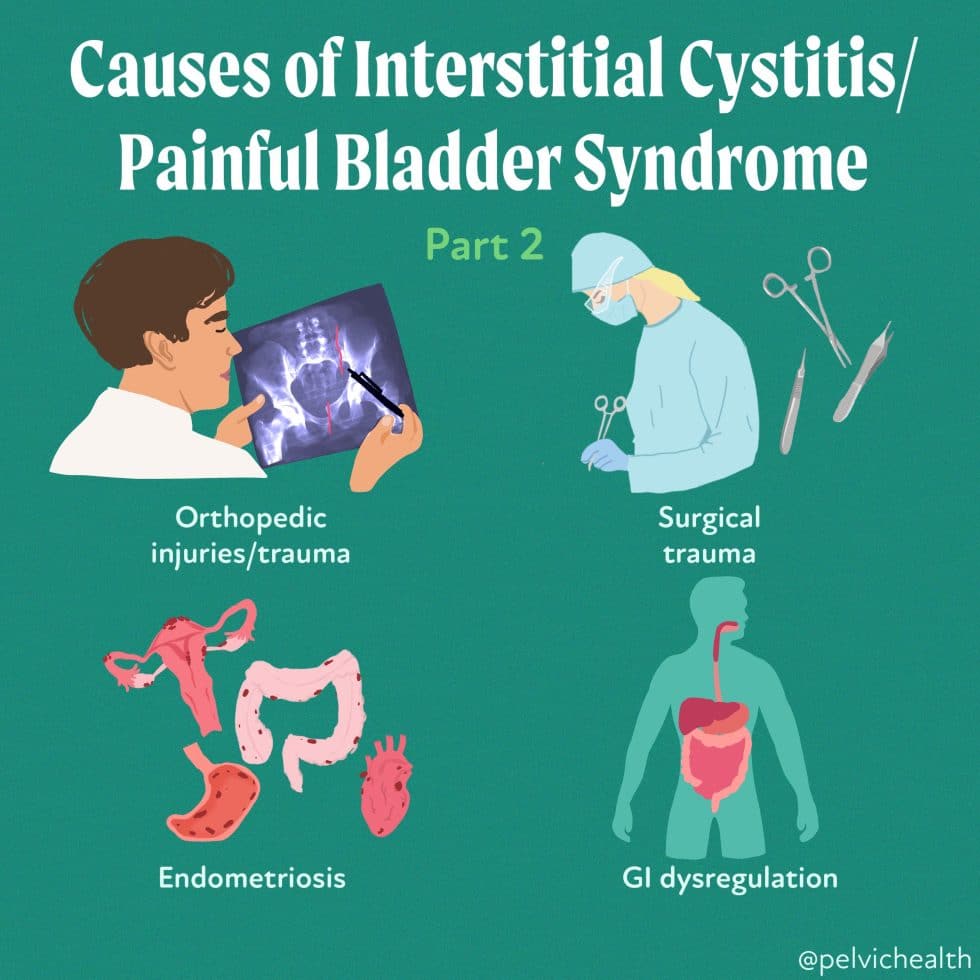 Causes of Interstitial Cystitis/Painful Bladder Syndrome