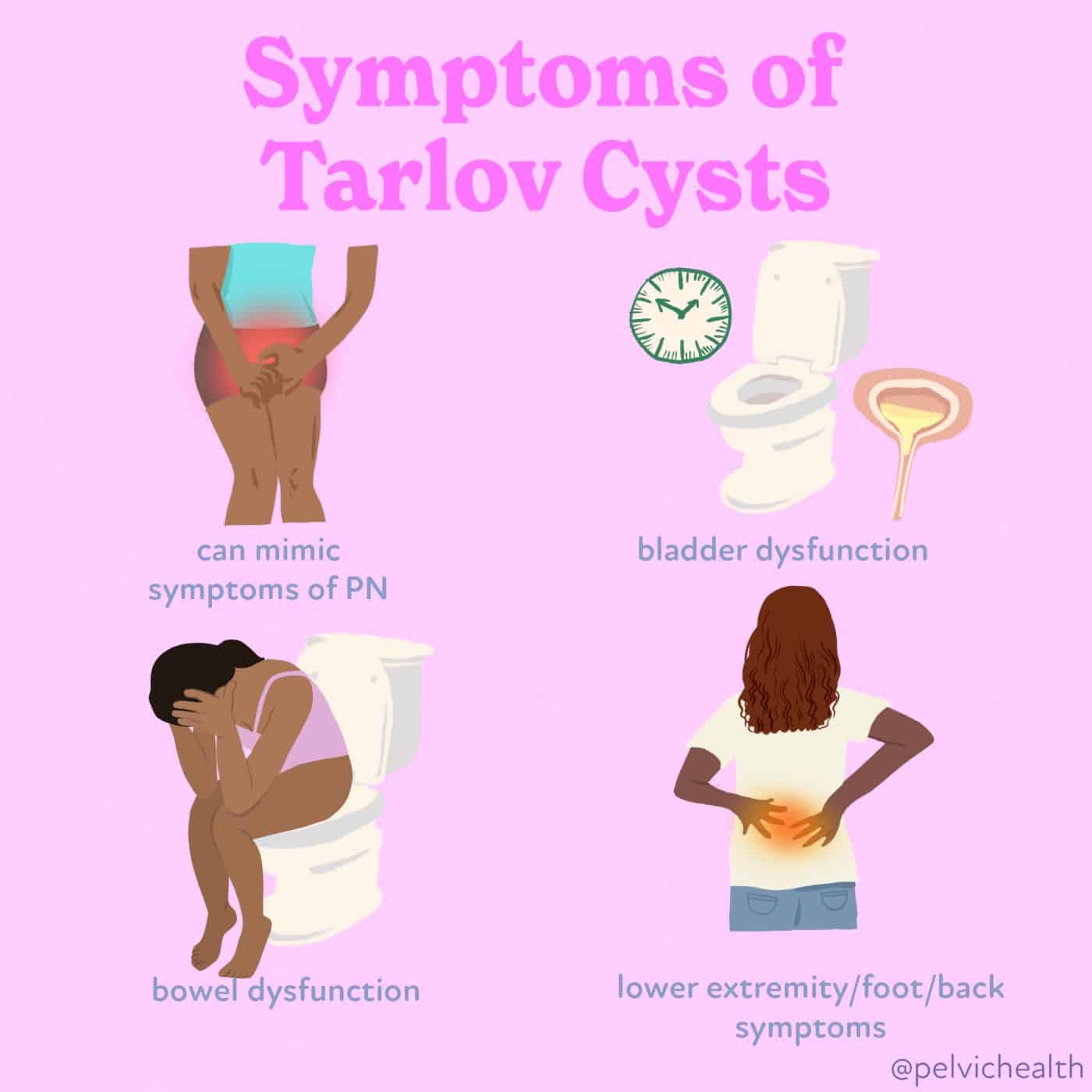 Tarlov Cysts Demystified: What You Need to Know | PHRC
