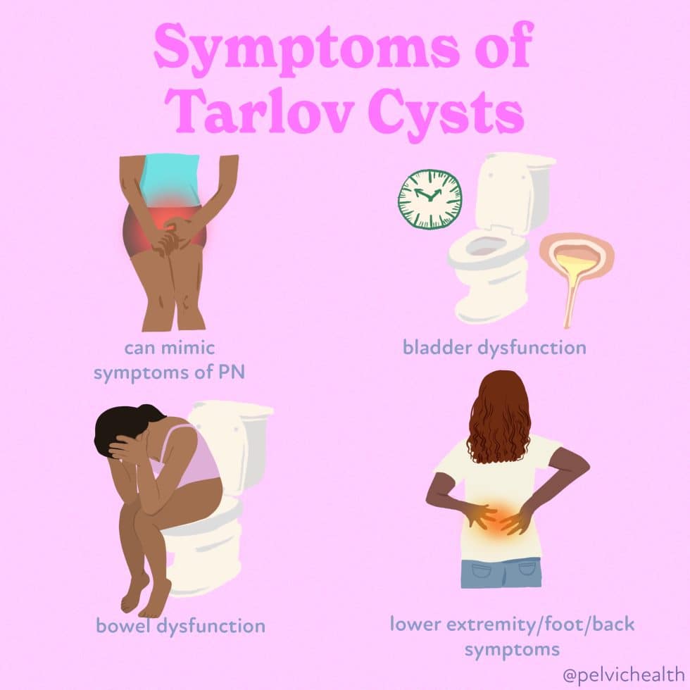 Tarlov Cysts Demystified: What You Need to Know | PHRC