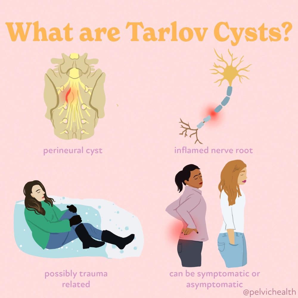 Tarlov Cysts Demystified: What You Need to Know | PHRC