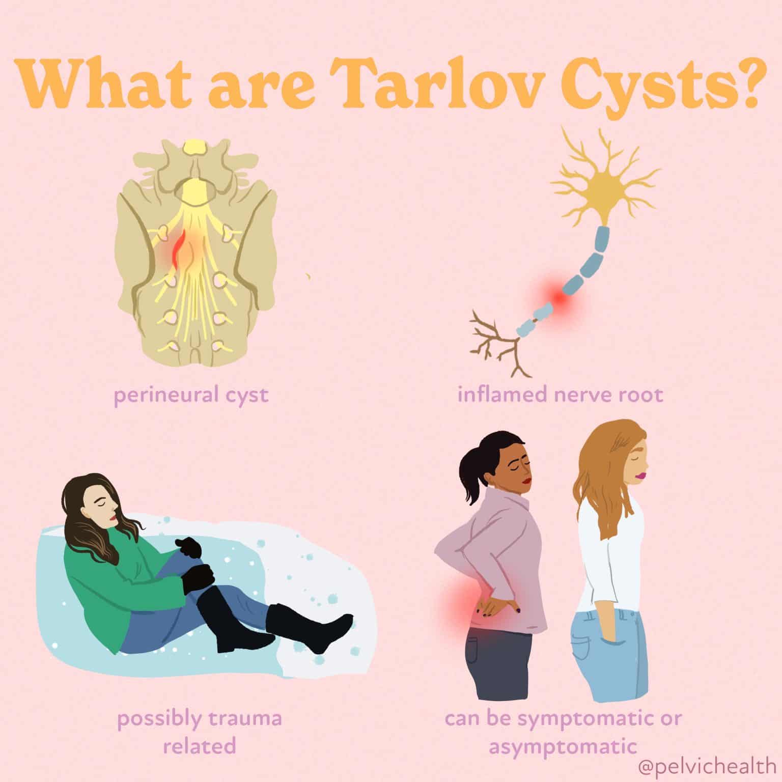 Tarlov Cysts Demystified: What You Need to Know | PHRC