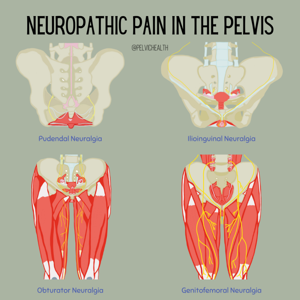 Neuropathic Pain in Pelvis: Q&A