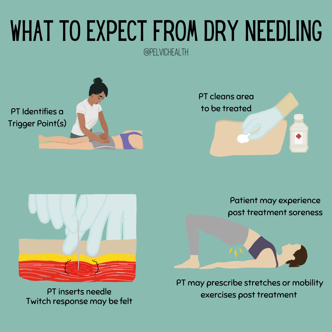 Dry Needling- How It’s Relevant To Pelvic Health