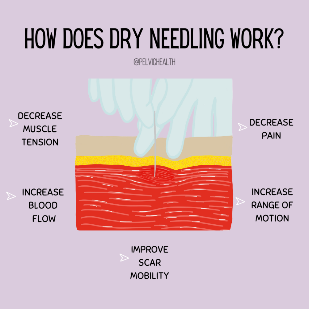 Dry Needling- How It’s Relevant To Pelvic Health
