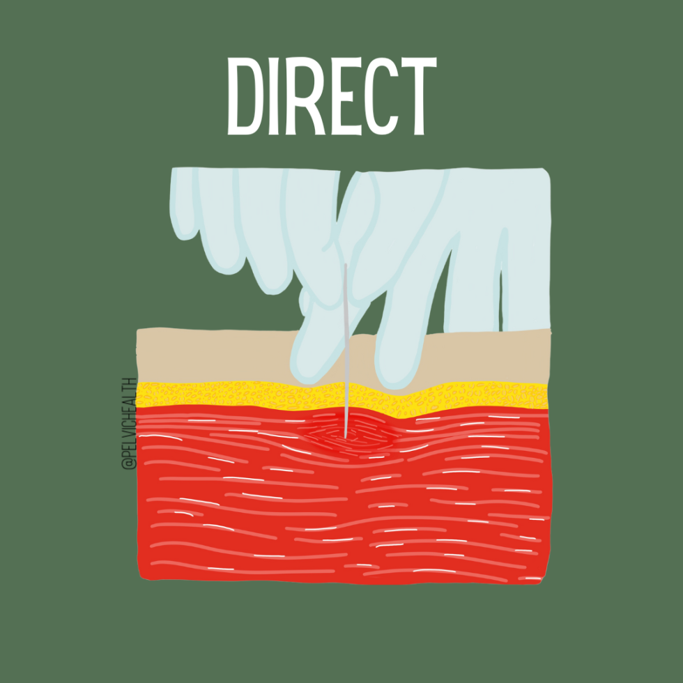 Dry Needling- How It’s Relevant To Pelvic Health