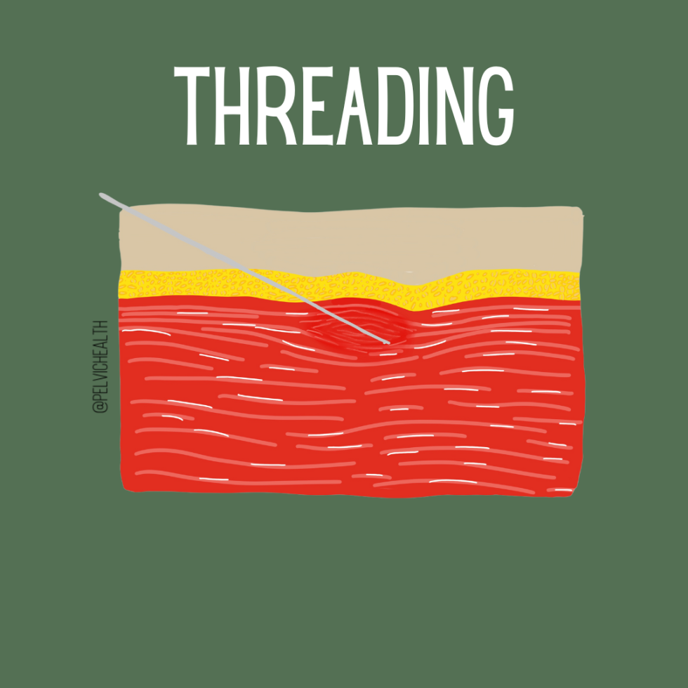 Dry Needling- How It’s Relevant To Pelvic Health