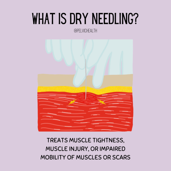 Dry Needling- How It’s Relevant To Pelvic Health