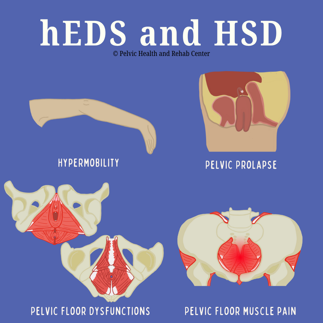 Pelvic Floor Therapy for EDS & Hypermobility